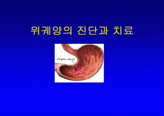 위궤양 및 십이지장궤양의 진단과 치료 (gastric ulcer diagnosis & treatment)