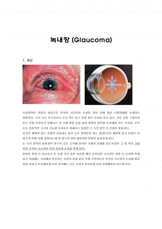 녹내장 (Glaucoma)