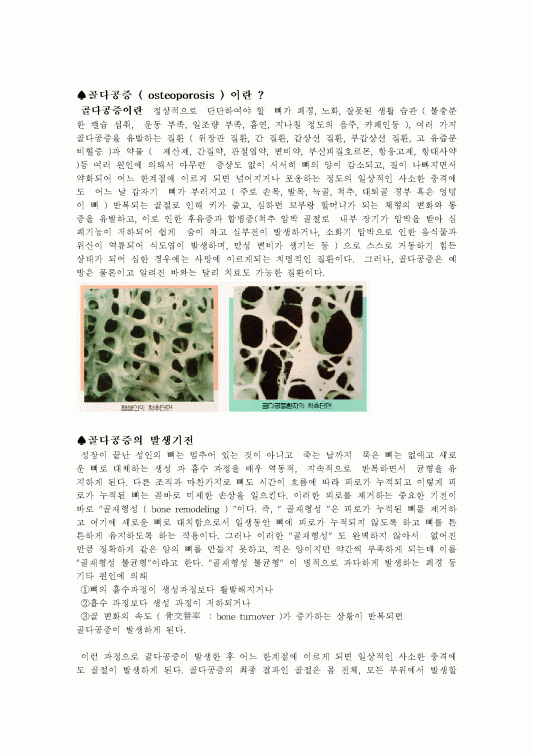 골다공증 ( osteoporosis )