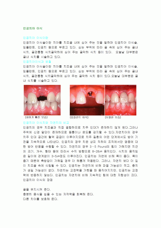 치아이식과 인공치아