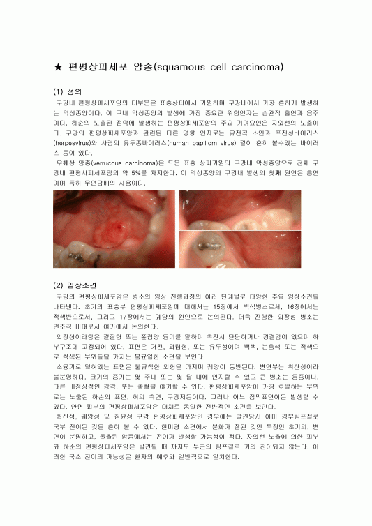 편평상피세포 암종과 재발성 아프타성 구내염
