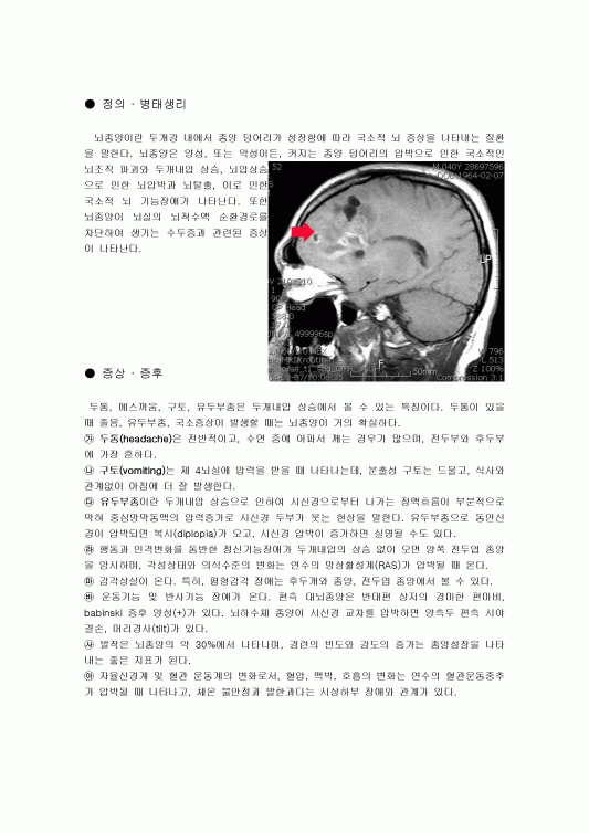 뇌종양 문헌고찰