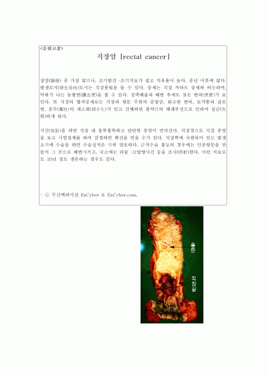 <문헌고찰>직장암 [rectal cancer]+교육자료까지 전부포함