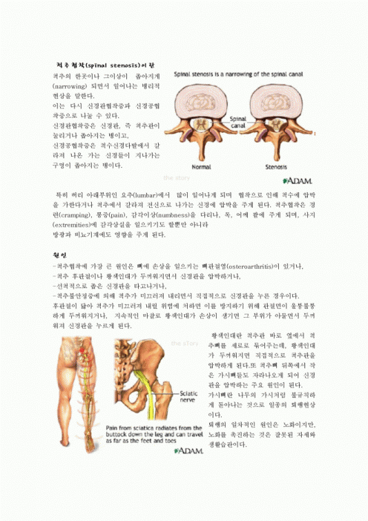 정형외과 케이스, 척추협착증 간호사례, 통증완화 방법, 낙상교육안