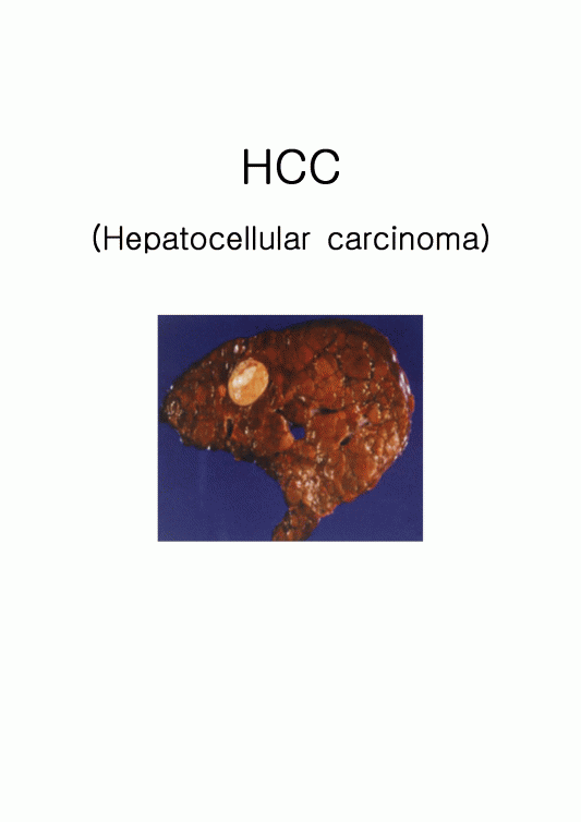 HCC (Hepatocellular carcinoma) 간세포암 케이스