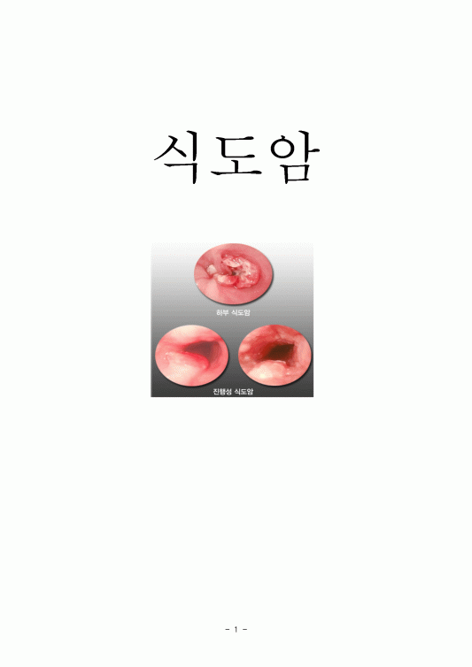 식도암 레포트 자료