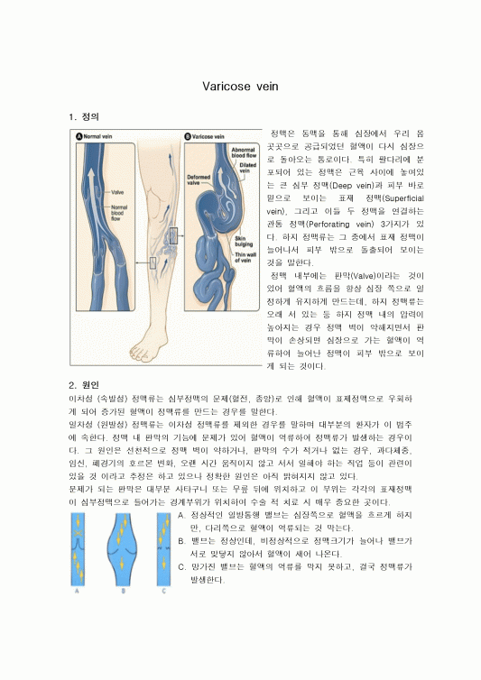 <성인간호학실습-수술실> varicose vein 하지정맥류 질병 고찰 (정맥류 정의, 정맥류 증상, 정맥류 원인, 정맥류 치료, 정맥류 분류, 정맥류 진단)